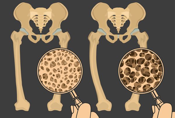 Rachitis Symptome: Daran erkennen Sie die Mangelkrankheit