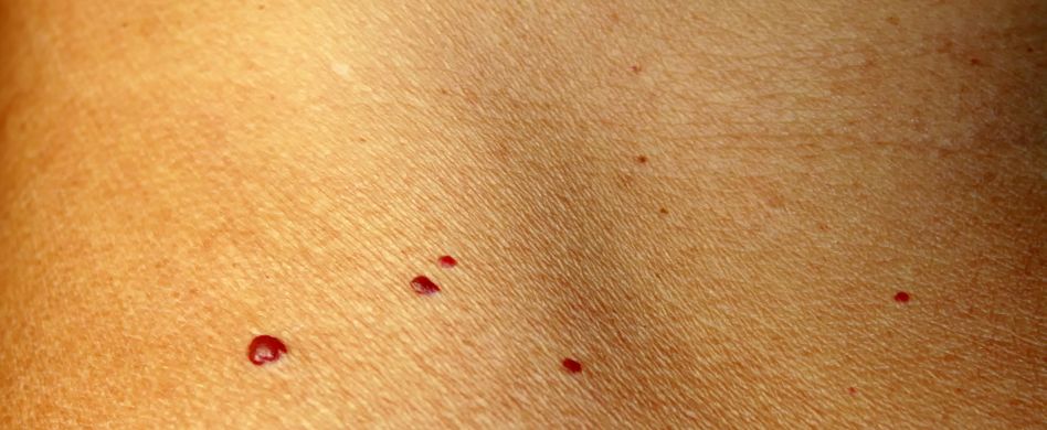 Rote Muttermale: Worum es sich bei roten Leberflecken handelt