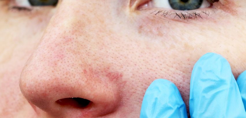 Rote Nase: Ursache für Couperose